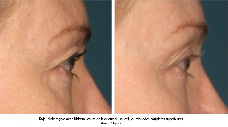 Ulthérapy Paris